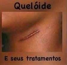 queloides tratamento in Cabinda